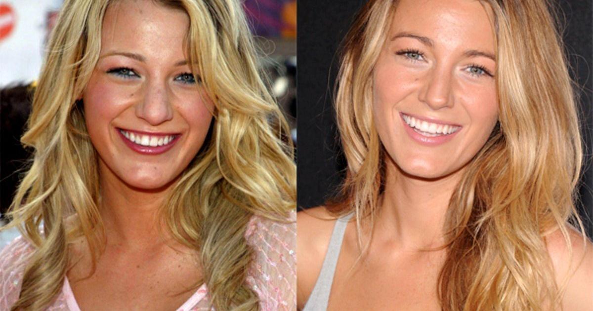 Blake Lively before & after: Η μοναδική πλαστική επέμβαση στην οποία η ...