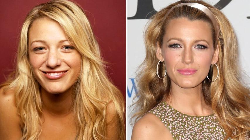 Blake Lively before & after: Η μοναδική πλαστική επέμβαση στην οποία η ...
